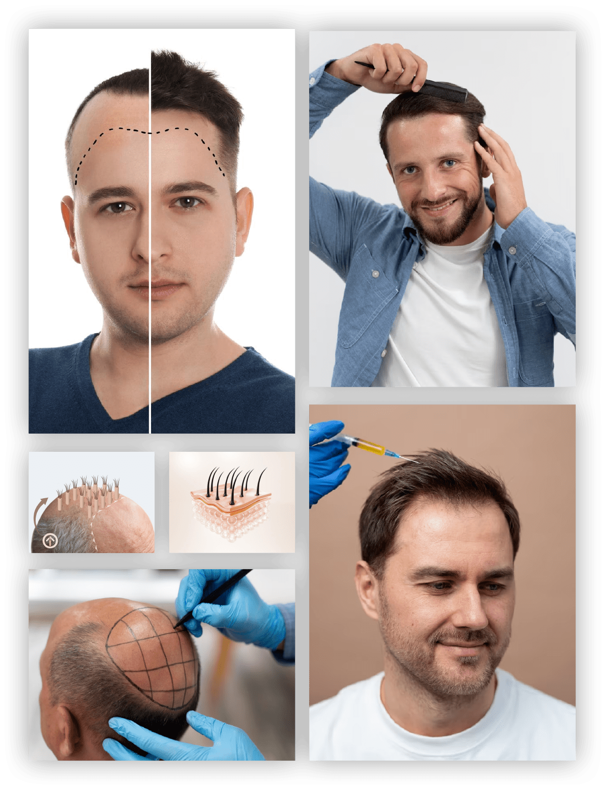 Hair Transplant – Macro Hair Systems
