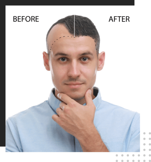 Before and After – Macro Hair Systems